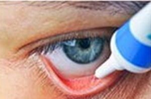 Terçol (Hordéolo) e Calázio: o que são, como tratar e quando se ...