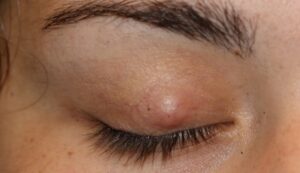 Terçol (Hordéolo) e Calázio: o que são, como tratar e quando se ...